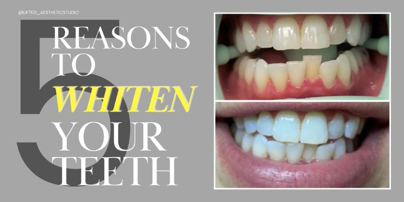 5 Reasons to Choose Teeth Whitening | Lifted Aesthetic